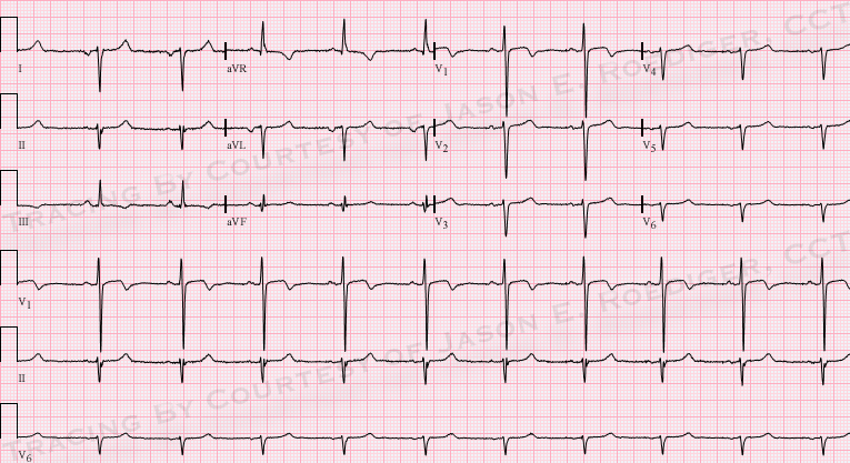 Mirror-image dextrocardia | ECG Guru - Instructor Resources